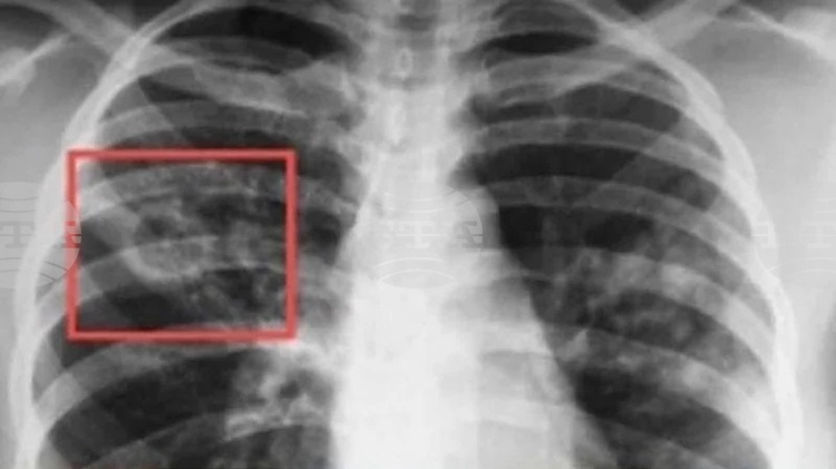 BTA :: Free Checkups for Tuberculosis Begin in All Regional Capitals